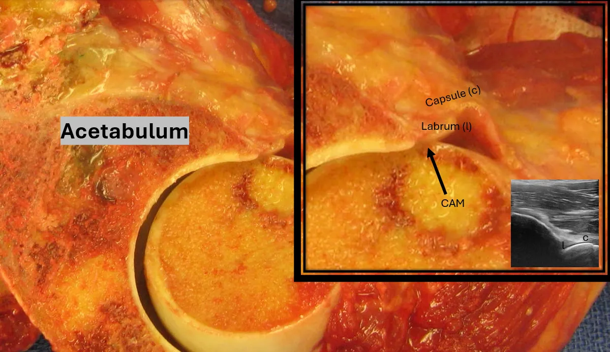 CAM effect on capsule and labrum in 60 degrees of flexion in a cadaver ...